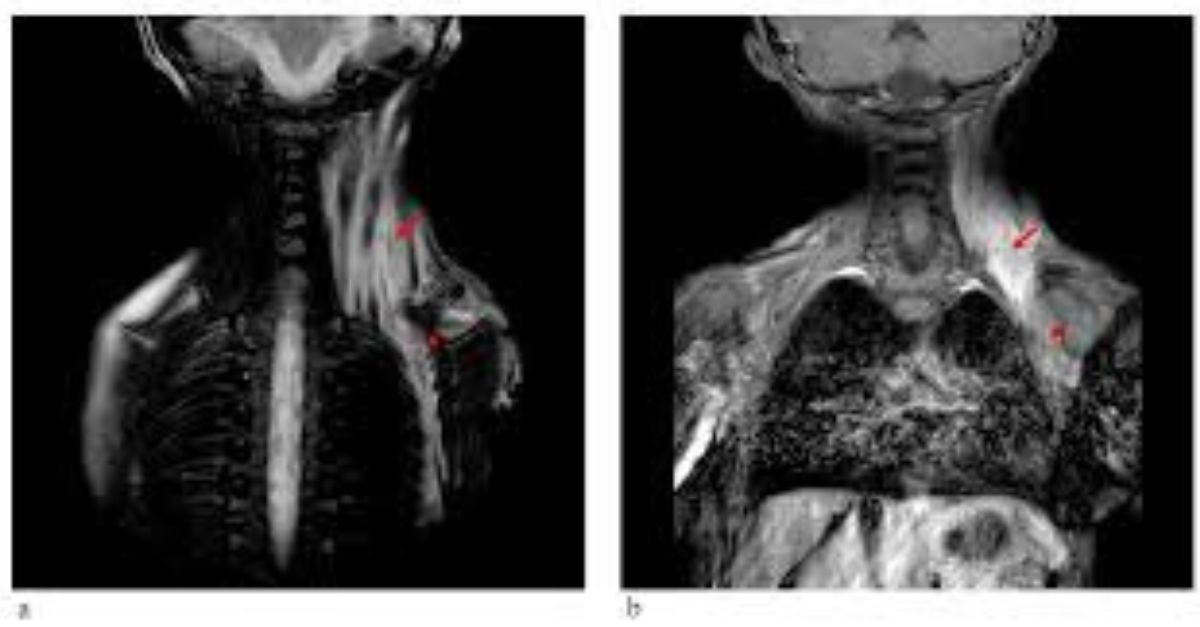 Successful Preimplantation Genetic Testing for Fibrodysplasia ...